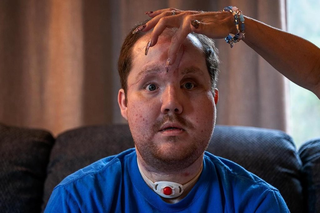 Trasplante de rostro a hombre que sobrevivió a suicidio